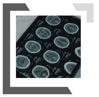 Global MS Research with the Neurostatus – EDSS – Improving data quality ...