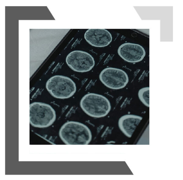 Global MS Research with the Neurostatus – EDSS – Improving data quality ...